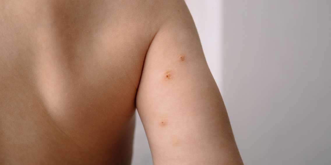 mollusca skin examples