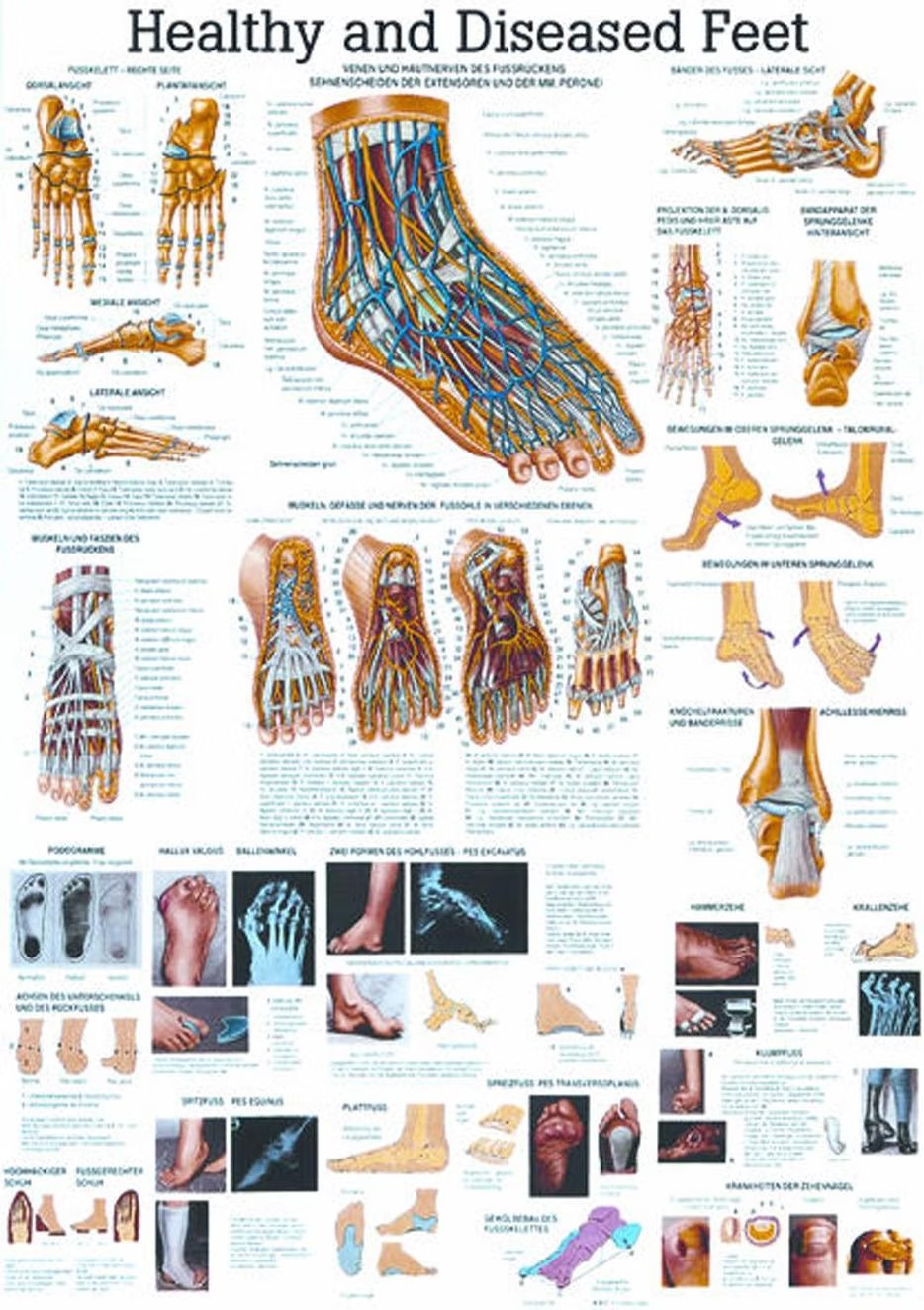 Rüdiger Anatomische Lehrtafel Gesunde & erkrankte Füsse 70 x 100 cm ...